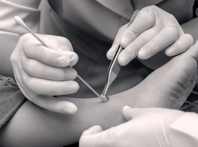 Debriding wounds to reduce bioburden - HealthTimes